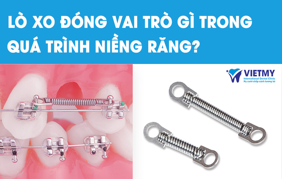 Lò Xo Niềng Răng Và Vai Trò Quan Trọng Trong Quá Trình Niềng Răng Mắc Cài